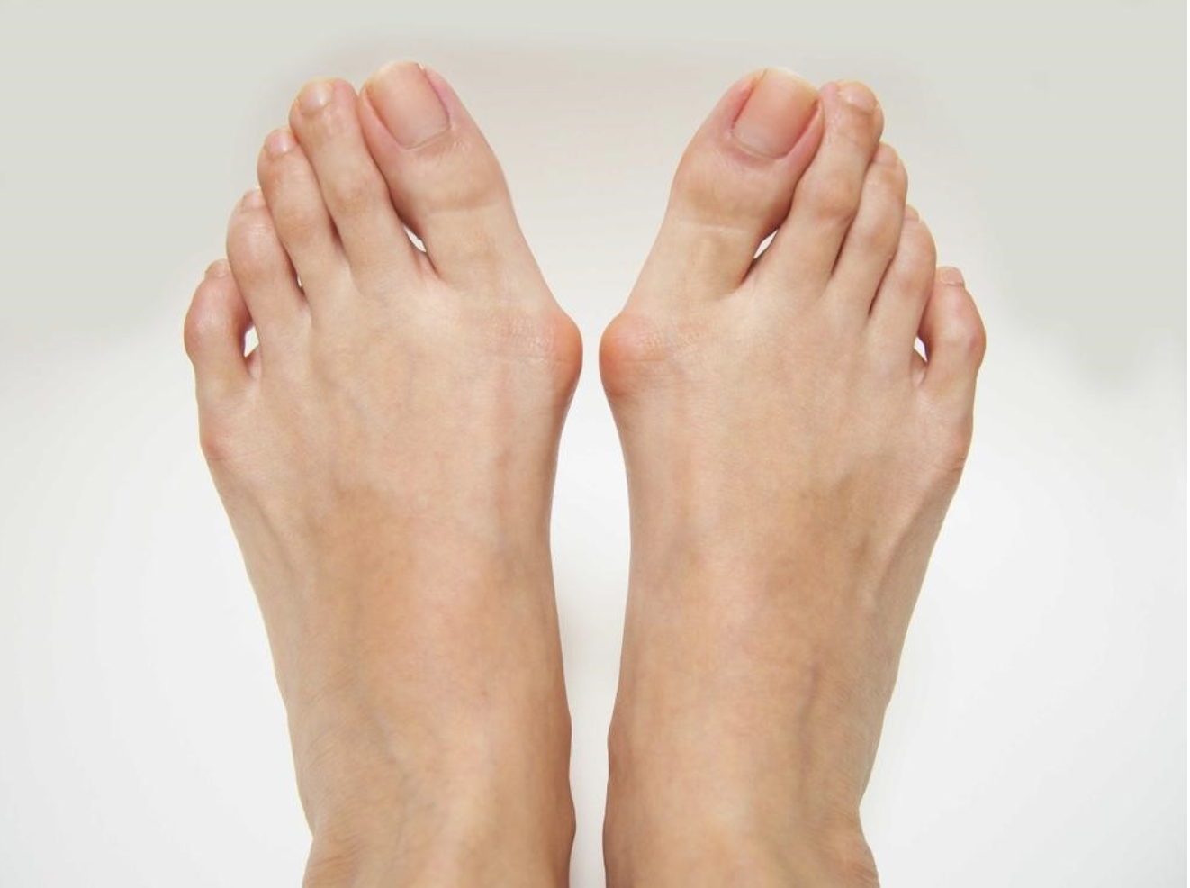 Bunion: When do I need to get it fixed? - Lone Star Foot & Ankle ...